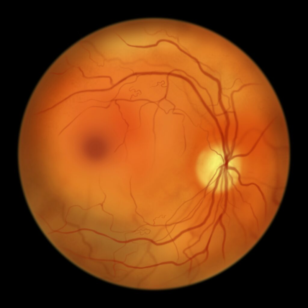 Non-proliferative,Diabetic,Retinopathy,,Illustration,Showing,Irmas ...